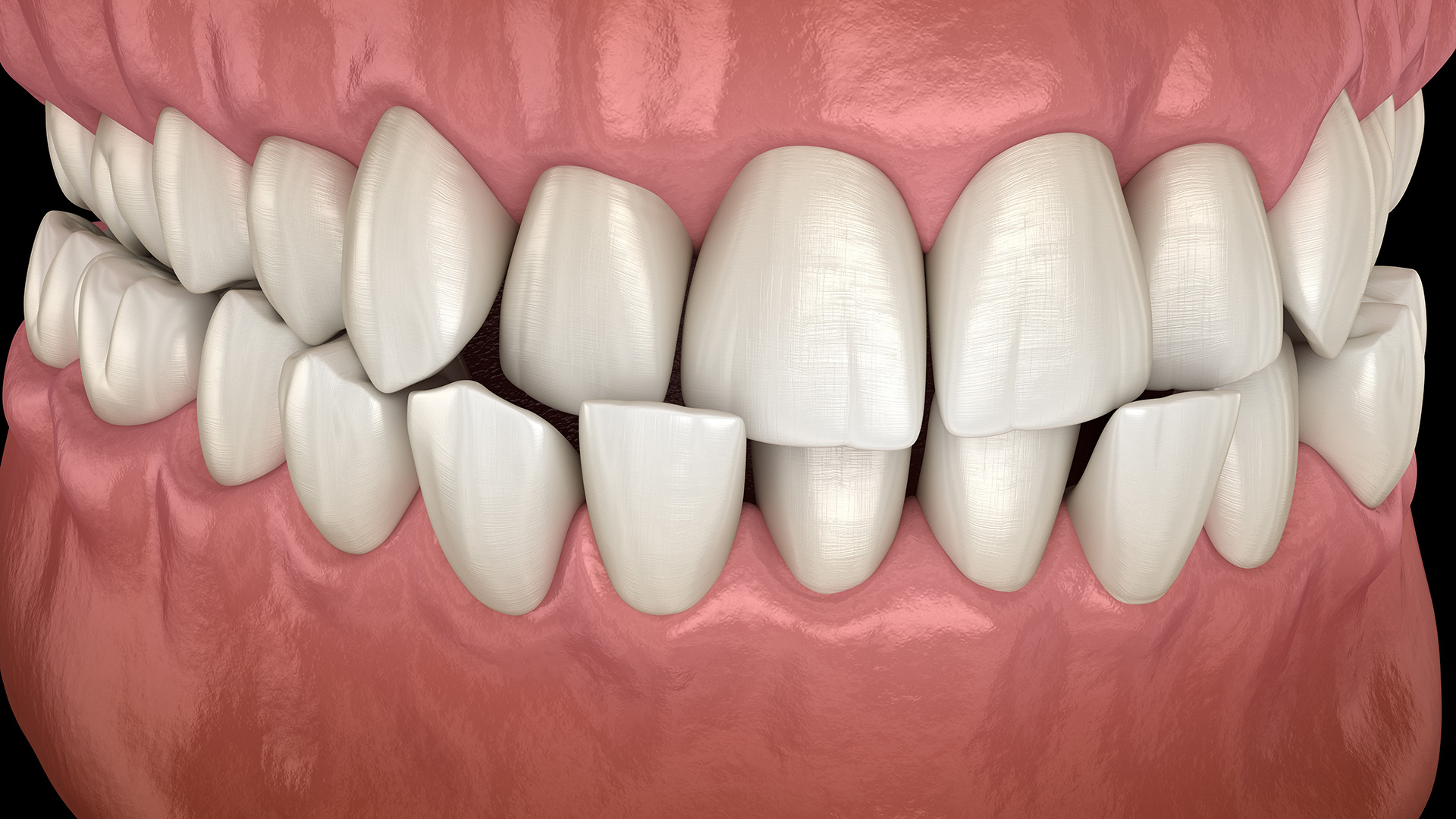 What is a Crossbite? Understanding Types, Causes & Treatments
