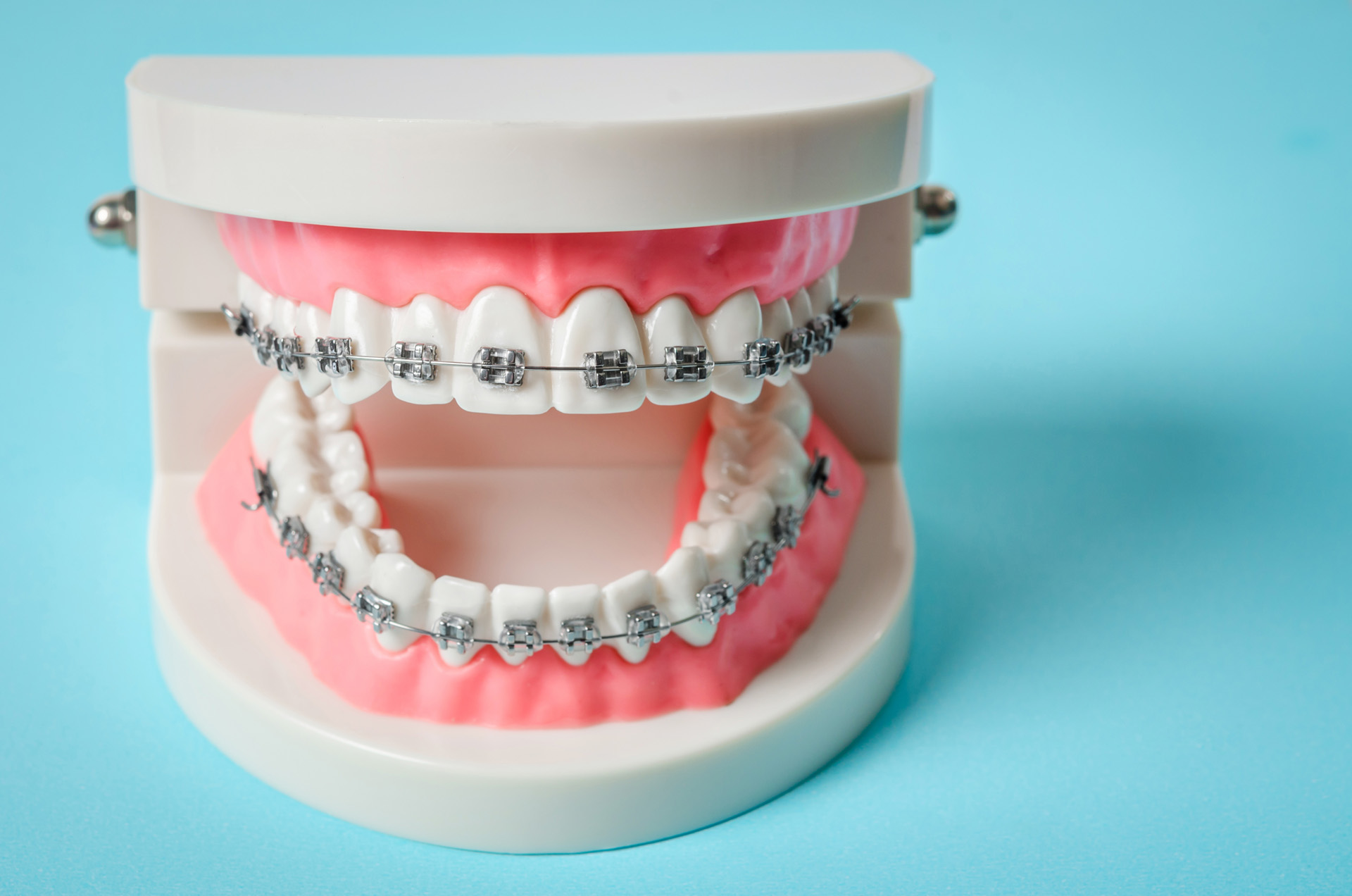 How Long Does It Take to Get Used to Braces? A Complete Guide