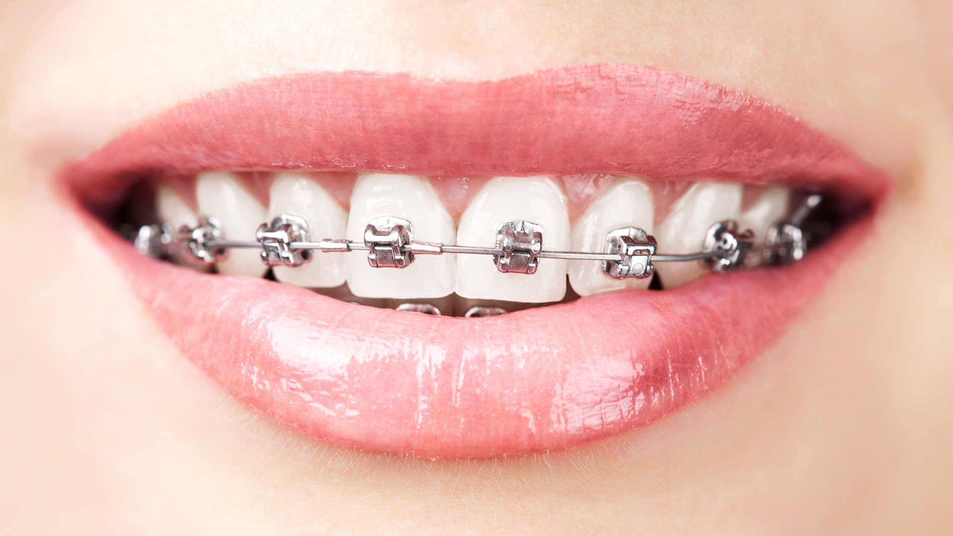 What Do Braces Feel Like? | Uncommon Orthodontics